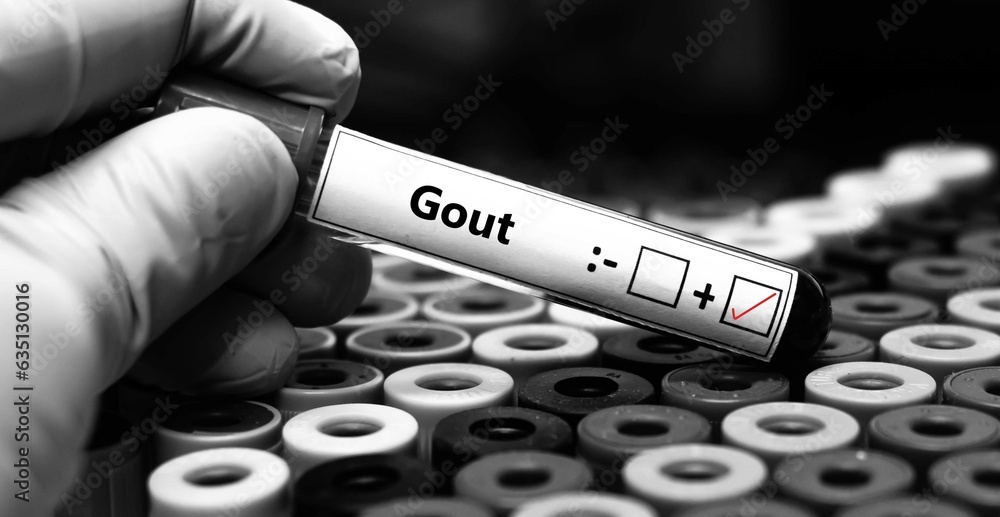 Blood sample of patient positive test for gout. Stock-Foto | Adobe Stock