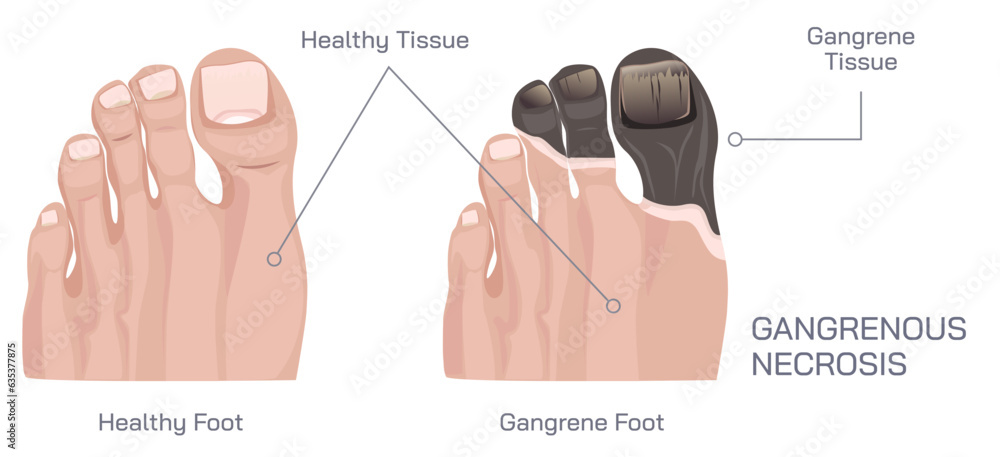 Healthy tissue and gangrene tissue. Gangrenous necrosis vector ...