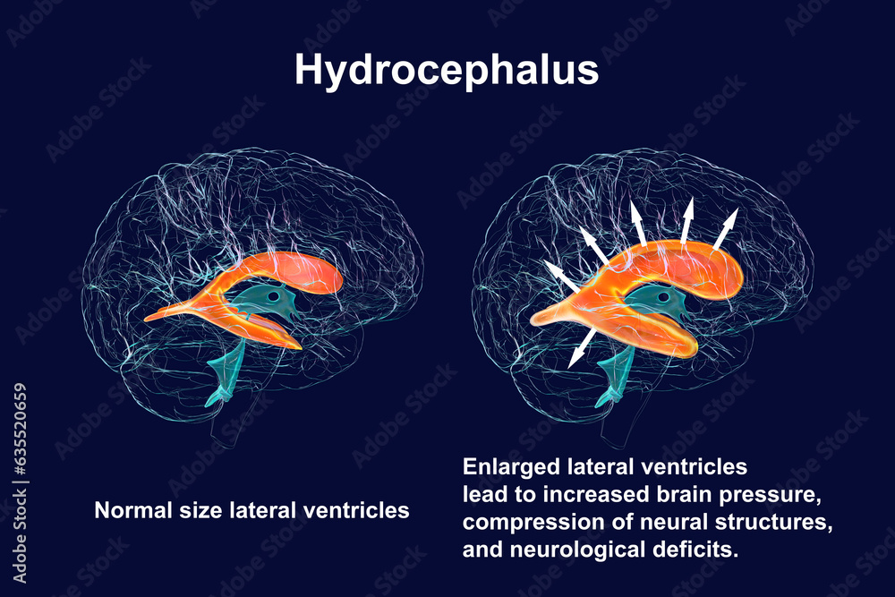 Fényképezés Enlarged lateral ventricles of the child brain and normal ...
