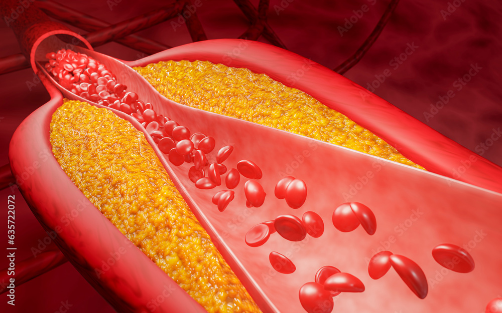 Hyperlipidemia. Blocked artery concept and human blood vessel as a ...
