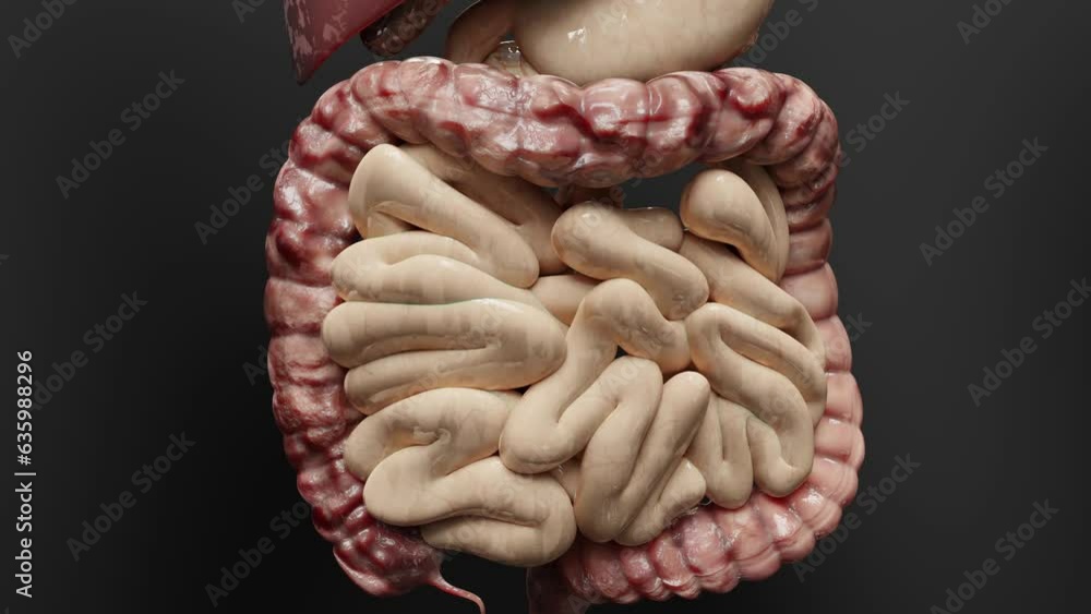 Bowel cancer or Colorectal tumor, Colon cancer, intestine inflammatory ...