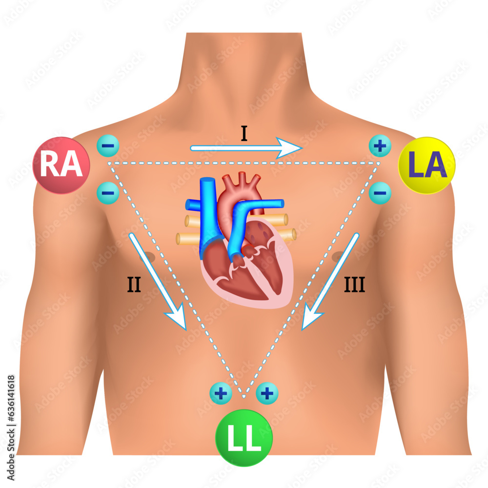 Standard Limb Leads ECG - Einthoven Triangle - Electrocardiogram Lead ... Standard Limb Leads ECG - Einthoven Triangle - Electrocardiogram Lead ...