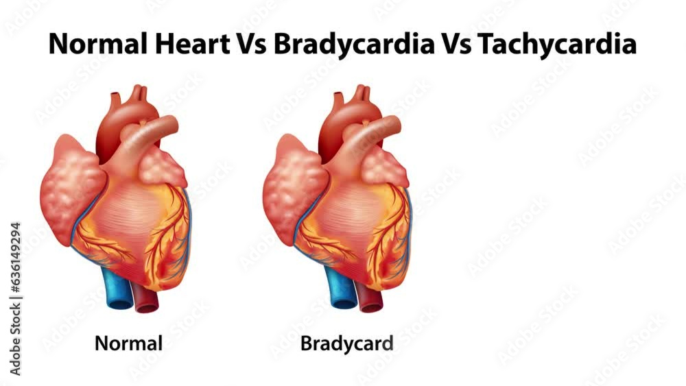 Infographic video comparing normal heart function to bradycardia and ...