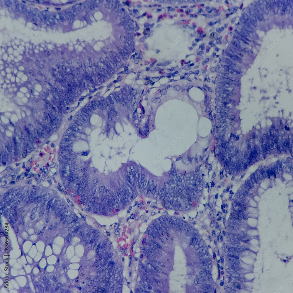 Camera photo of dysplastic colonic epithelium comparing to normal ...