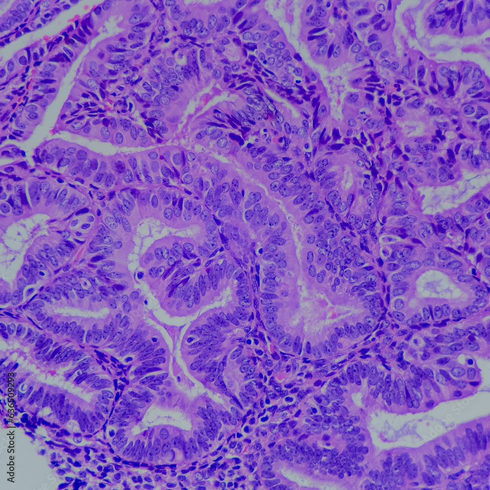 Camera photo of atypical endometrial hyperplasia, showing endometrial ...