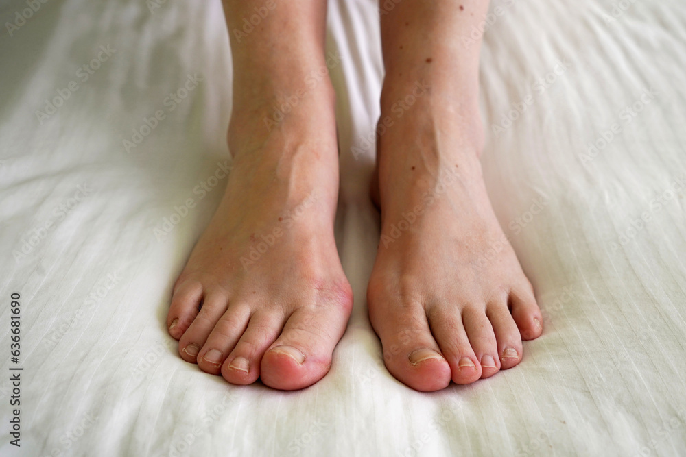female legs with problem with women's feet, bunion toes in bare feet ...