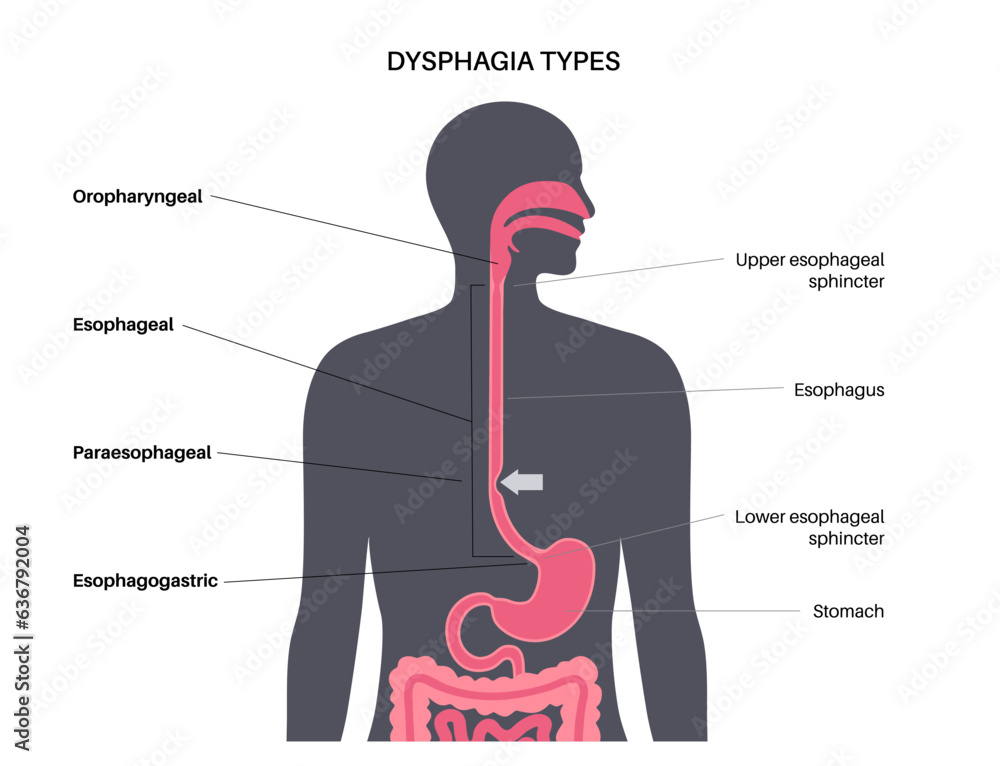 Dysphagia medical poster Stock Vector | Adobe Stock