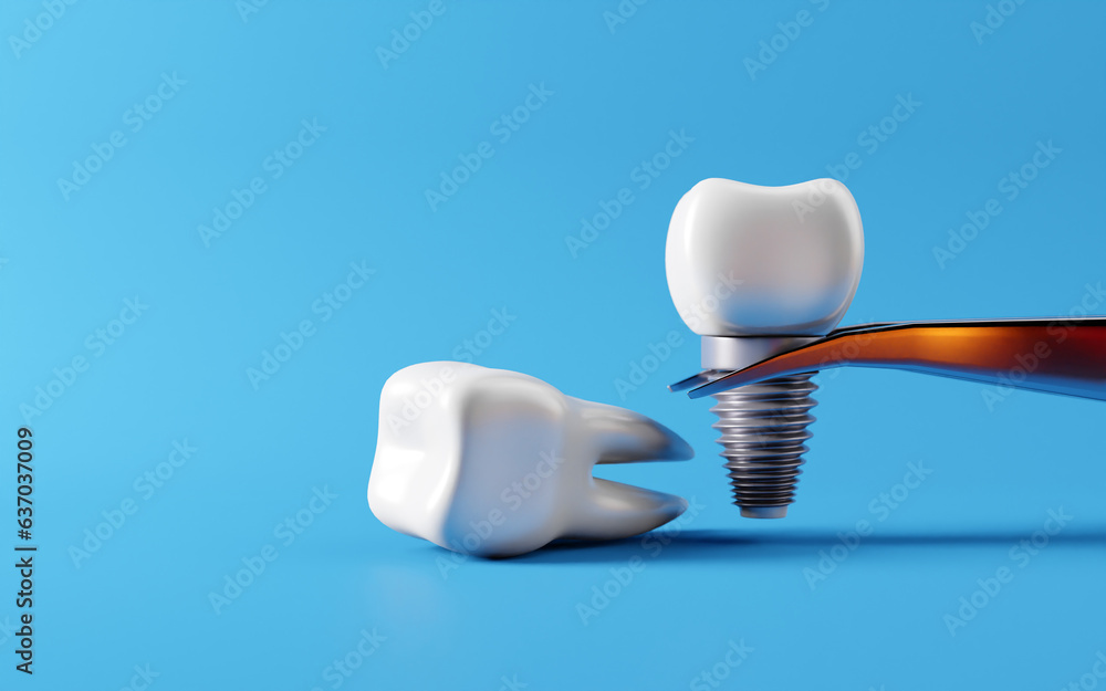 Dental teeth implants and Root caries. Oral health and dental ...