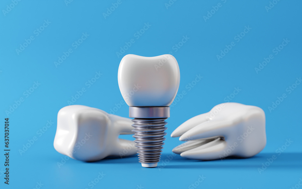 Dental teeth implants and Root caries. Oral health and dental ...