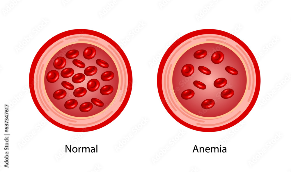 Iron deficiency anemia. The difference of Anemia amount of red blood ...
