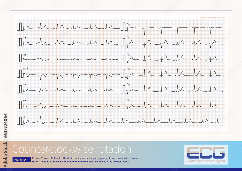 Counterclockwise rotation is a common ECG phenomenon, with an RS ...