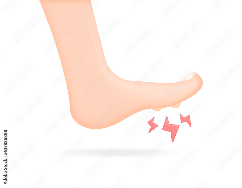 Clavus disease. There is a fisheye lump on the sole of the foot ...