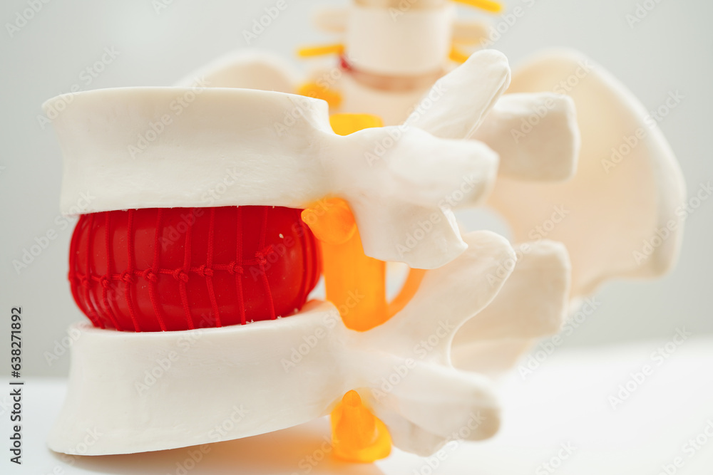 Spinal nerve and bone, Lumbar spine displaced herniated disc fragment ...