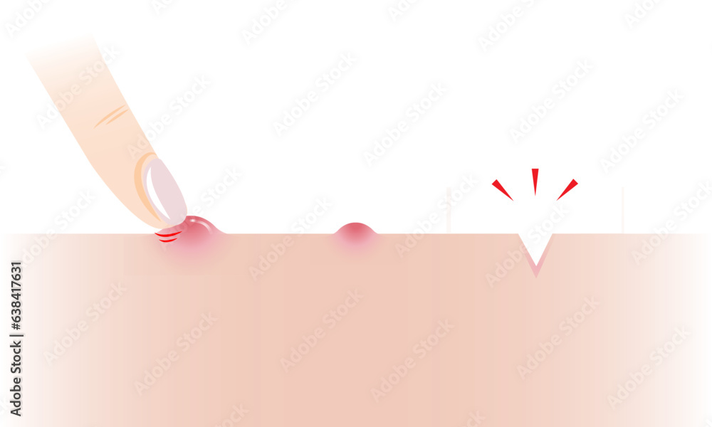 Step of popping pimple to icepick scar vector illustration on white ...