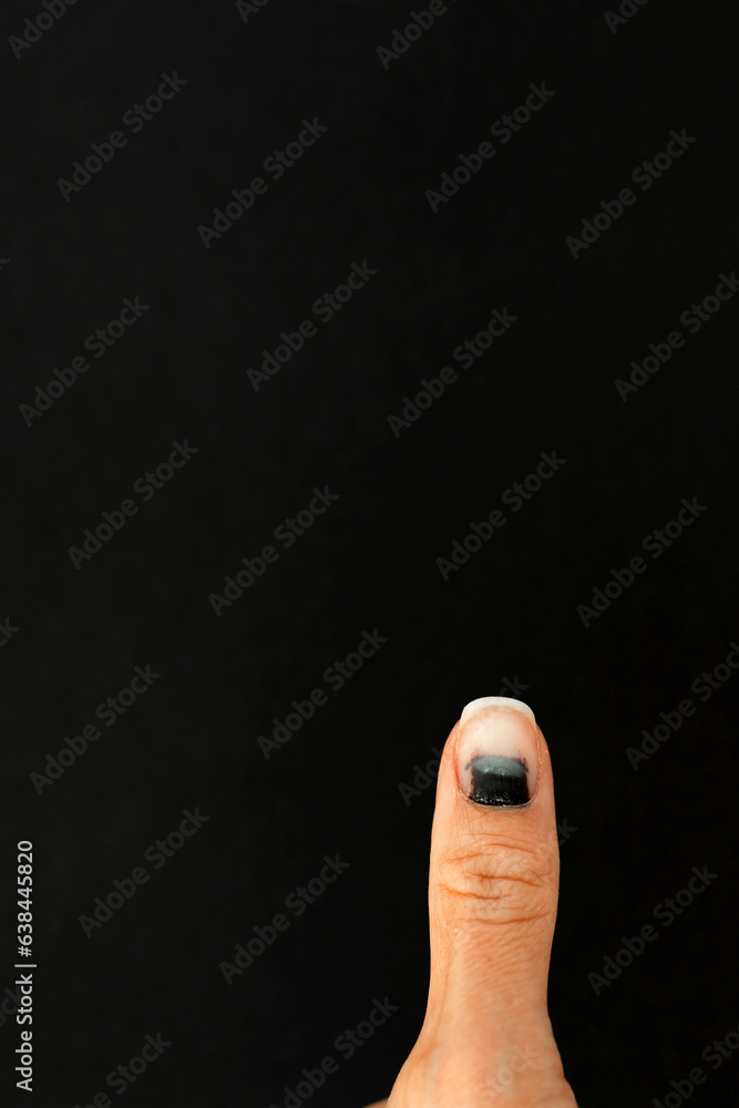 Subungual hematoma present under the toenail of the hallux, more ...