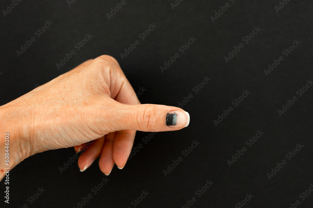 Subungual hematoma present under the toenail of the hallux, more ...