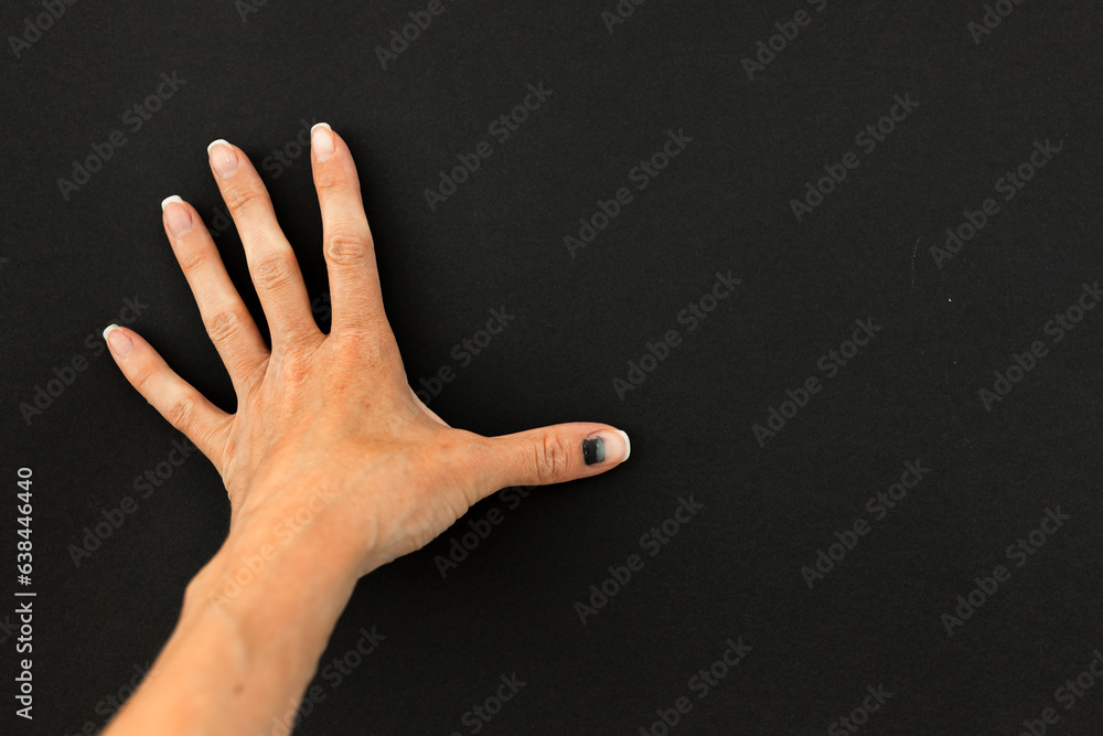 Subungual hematoma present under the toenail of the hallux, more ...