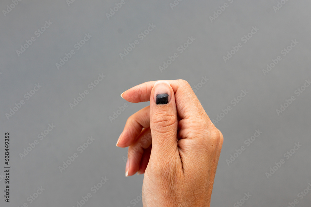 Subungual hematoma present under the toenail of the hallux, more ...