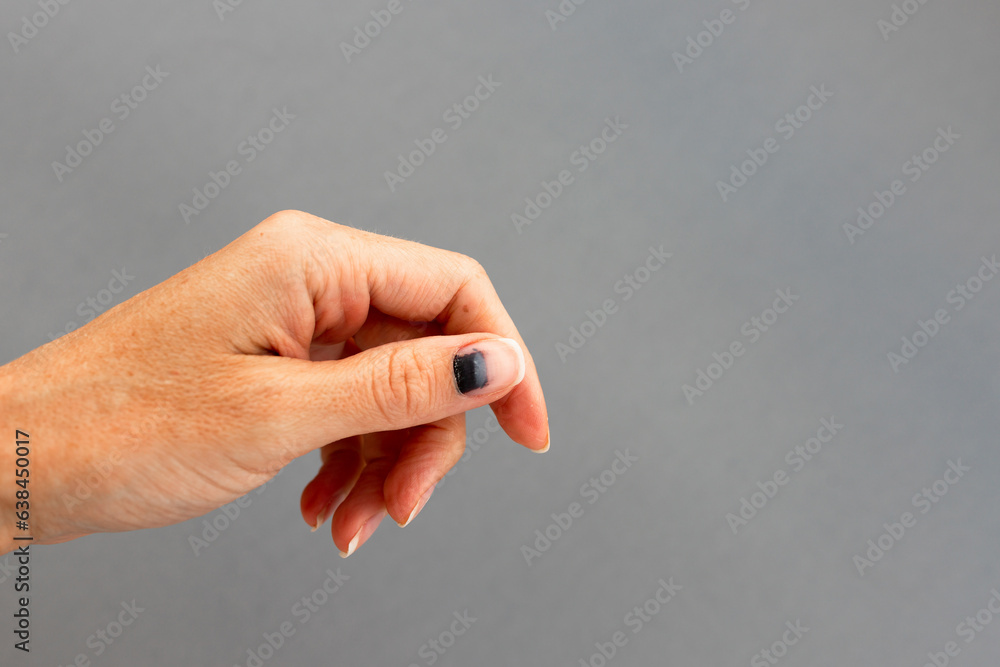 Subungual hematoma present under the toenail of the hallux, more ...