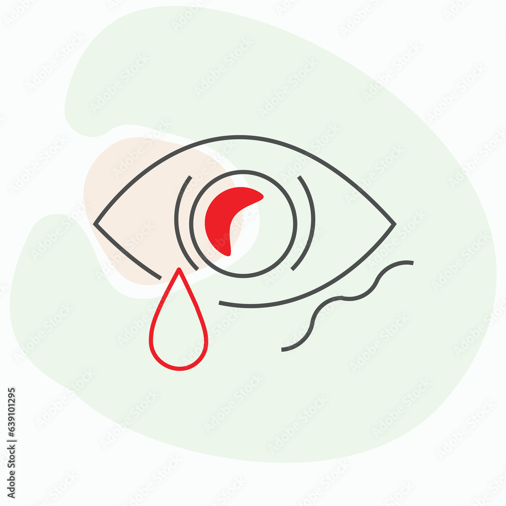 Dry eye syndrome, also known as keratoconjunctivitis sicca or dry eye ...