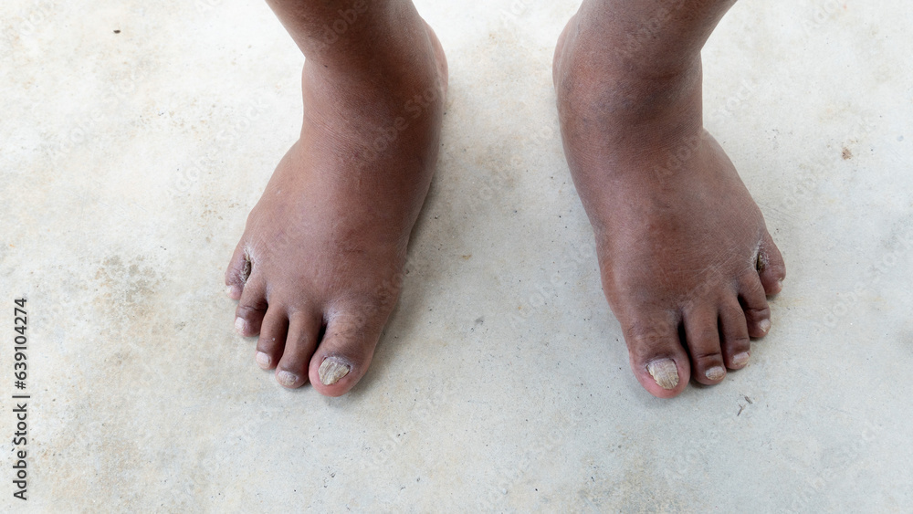 Above view of swollen feet on both sides. health problems of the ...