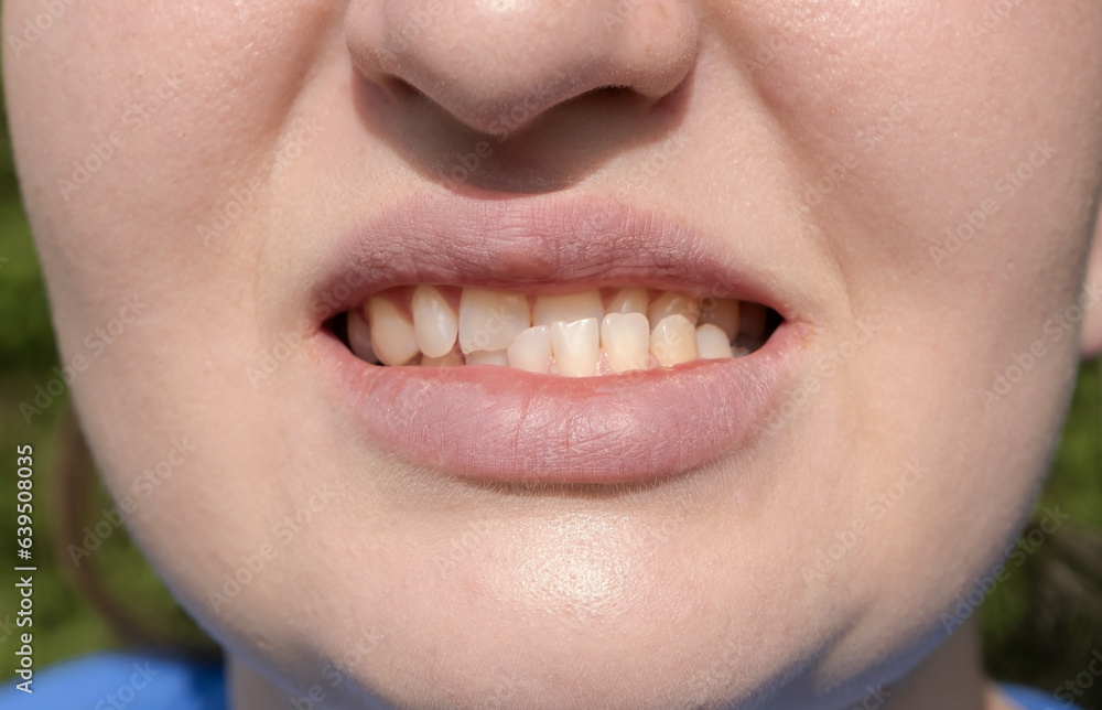 Patient woman with dislocated jaw and malocclusion, temporomandibular ...