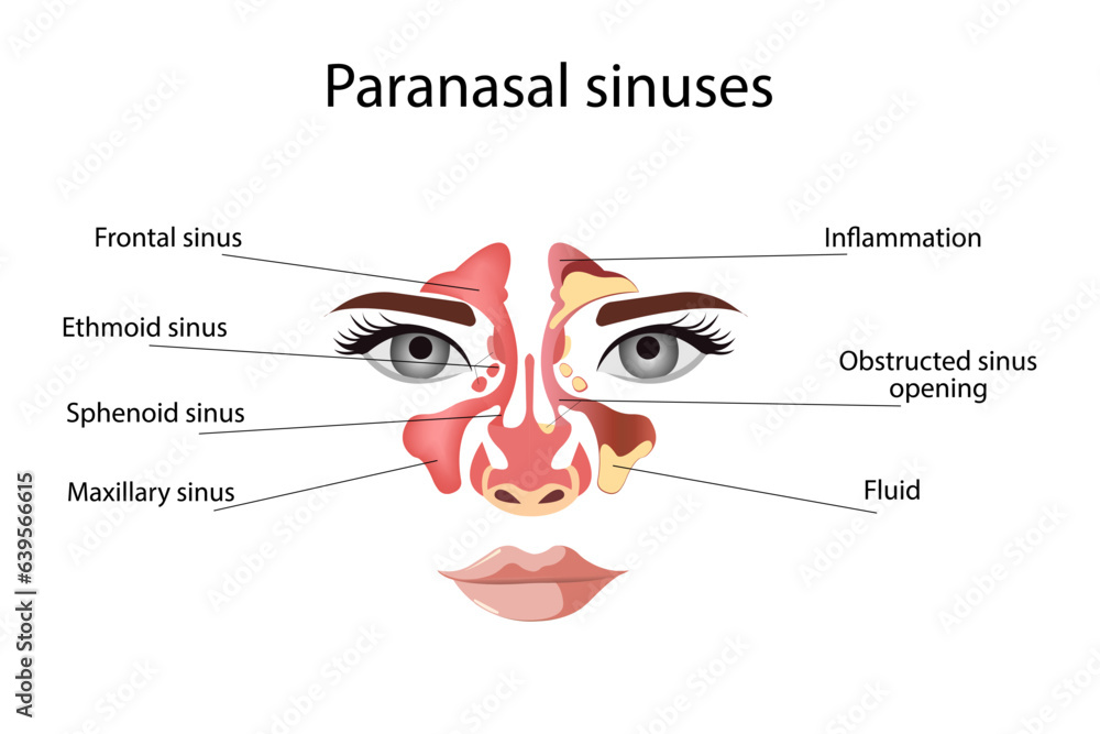 Sinusitis, Female face with inflammation of the mucous membrane of the ...