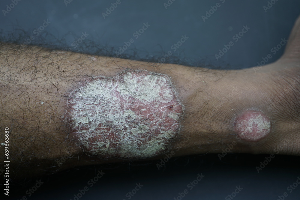 Leg with a fungal disease on a white background ,psoriasis Stock Photo ...