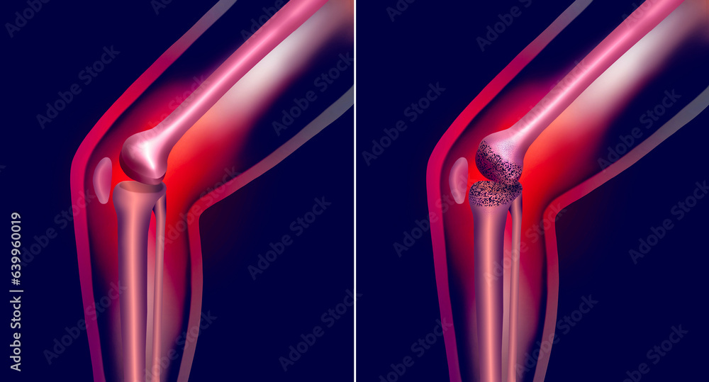 Arthrosis medical illustration diagram with damaged knee structure and ...