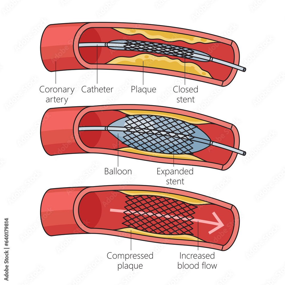 Diagram of coronary stent placement schematic raster illustration ...