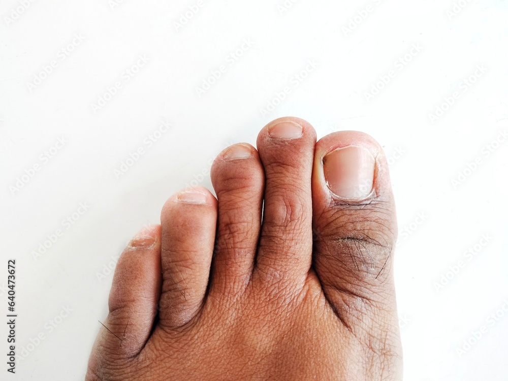 left toes of a caucasian man with dry skin and untidy nails isolated on ...