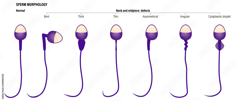 Normal with Neck and midpiece defects spermatozoon. Semen analysis ...