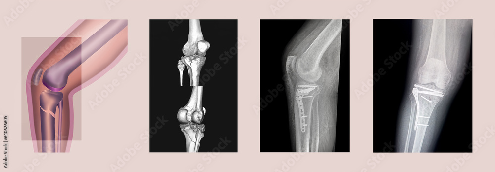Structure of knee and rx-ray image of knee, tibia fracture with post ...