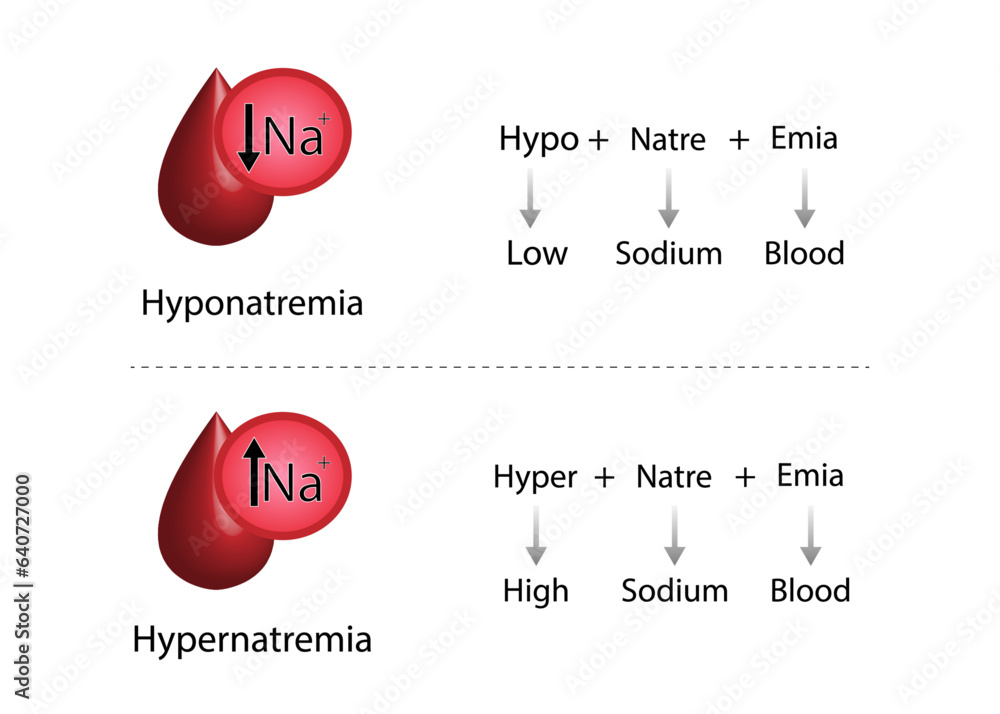 Vecteur Stock Hypernatremia, high plasma sodium level and Hyponatremia ...