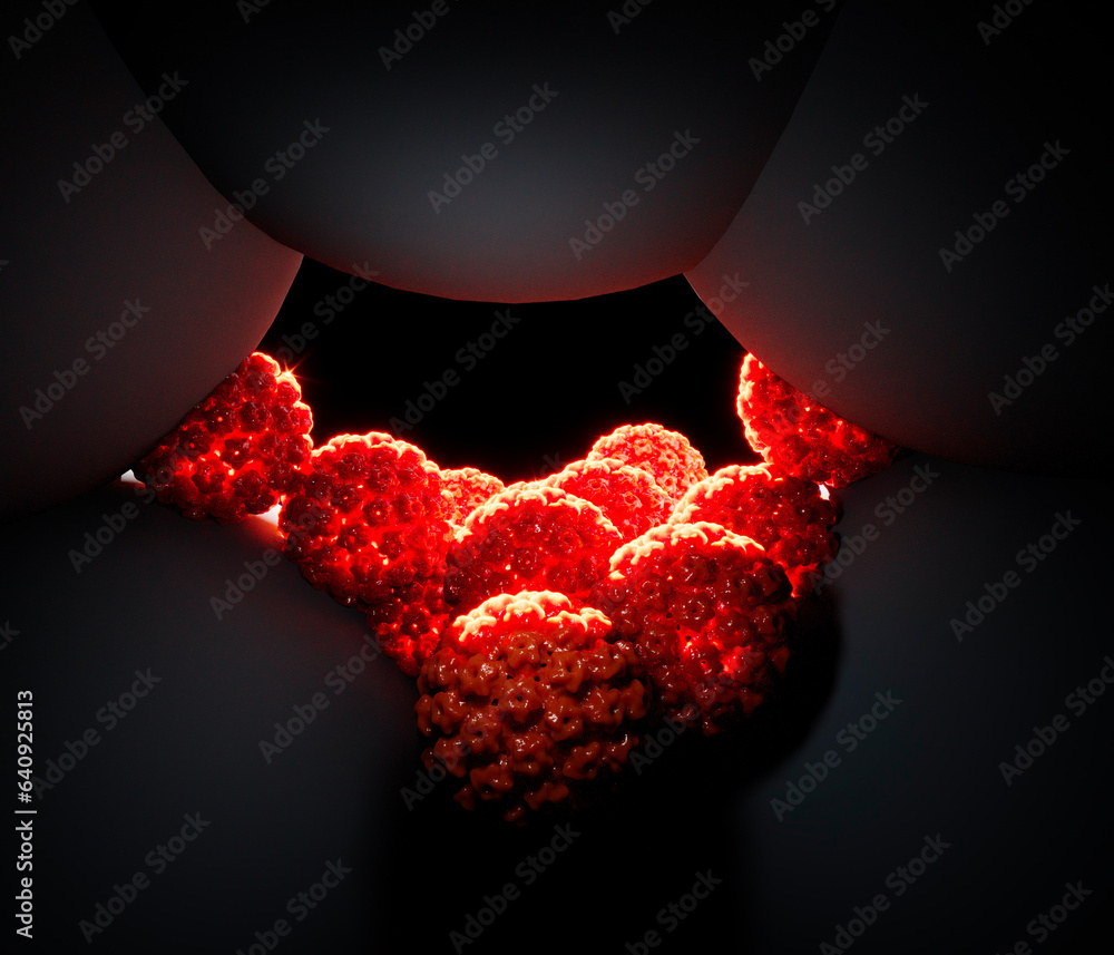 Human Papillomavirus Infection Virus Hpv Is The Most Common Sexually