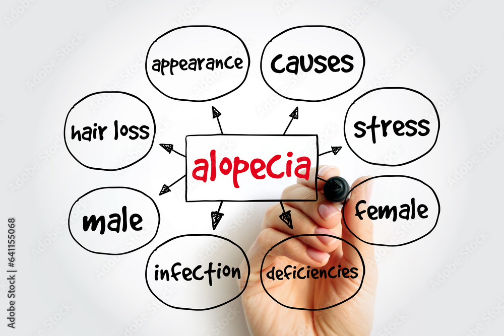 Alopecia mind map, medical concept for presentations and reports Stock ...