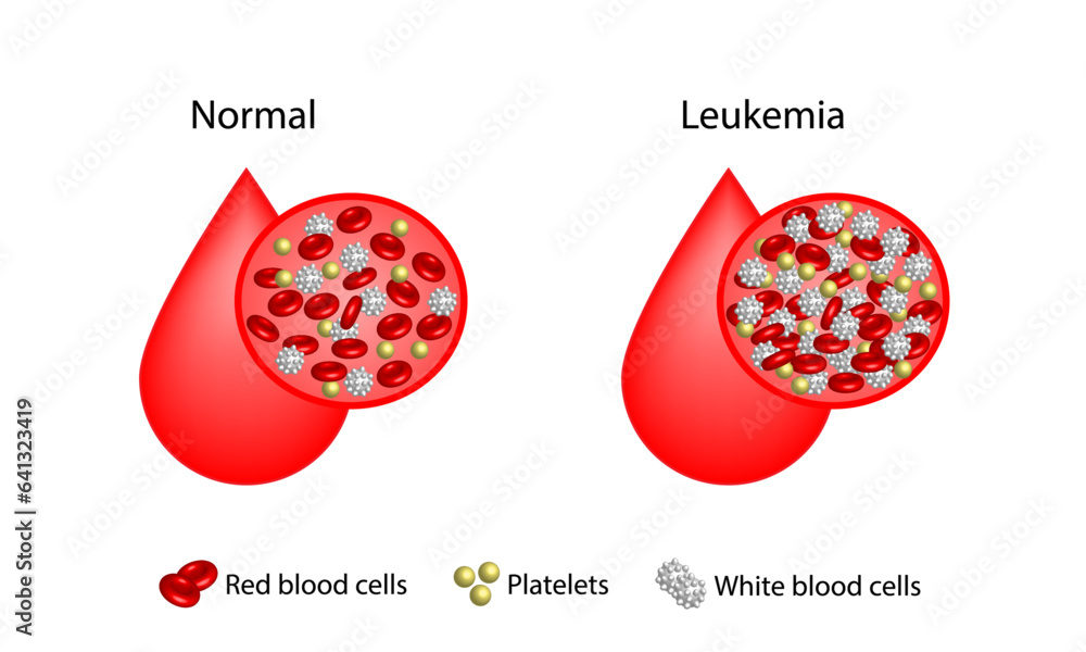 Leukemia, blood cancer. Difference between healthy normal blood and ...