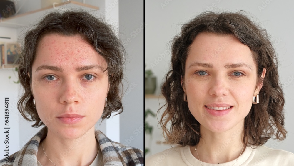Two close up faces of young beautiful woman show real result before and ...