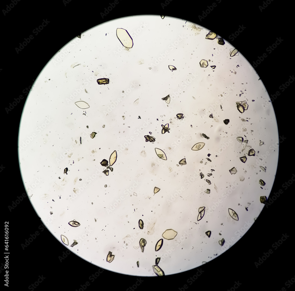 Photomicrograph of Uric acid crystal in urine sediment Stock Photo ...