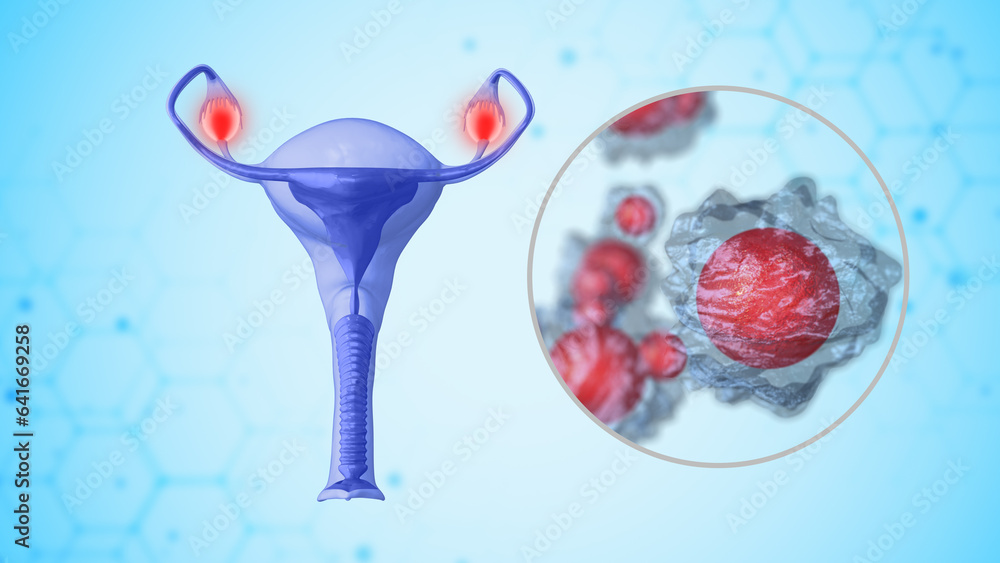 The female reproductive system's infected ovaries Stock Illustration ...
