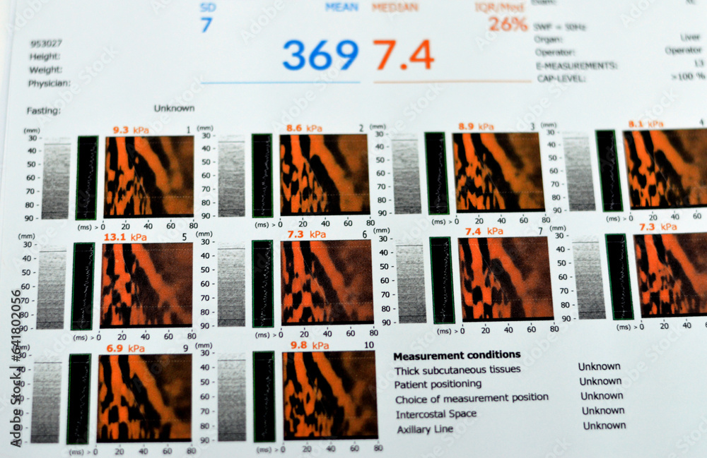 Fibroscan examination study of the liver revealed F2 for liver ...