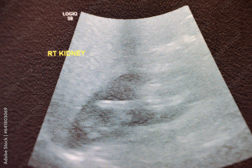 Right kidney in pelviabdominal ultrasonography reveals average size ...