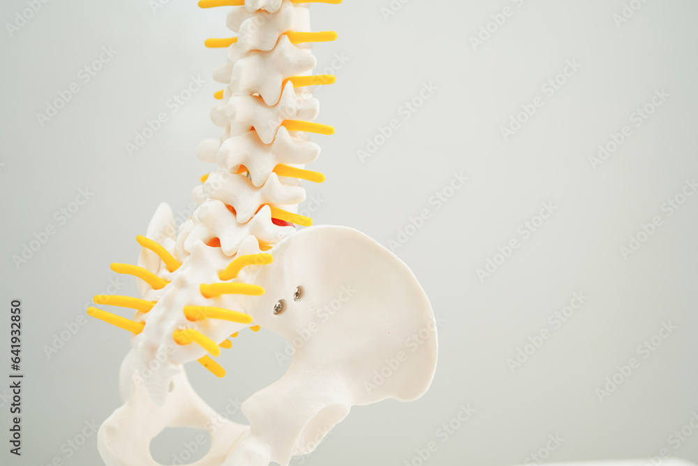 Spinal nerve and bone, Lumbar spine displaced herniated disc fragment ...