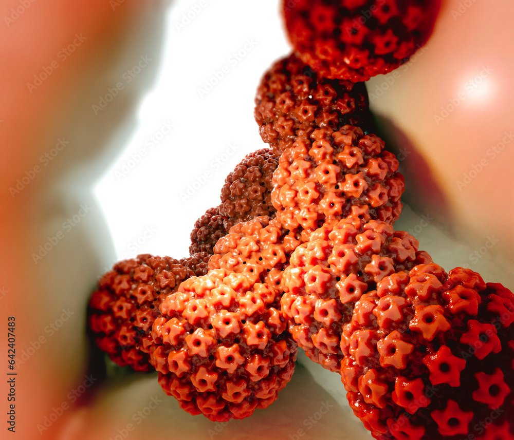 Human papillomavirus infection. Virus. HPV is the most common sexually transmitted infection ...