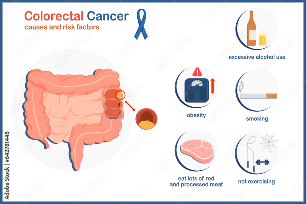 medical vector illustration Causes and risk factors that cause colon ...
