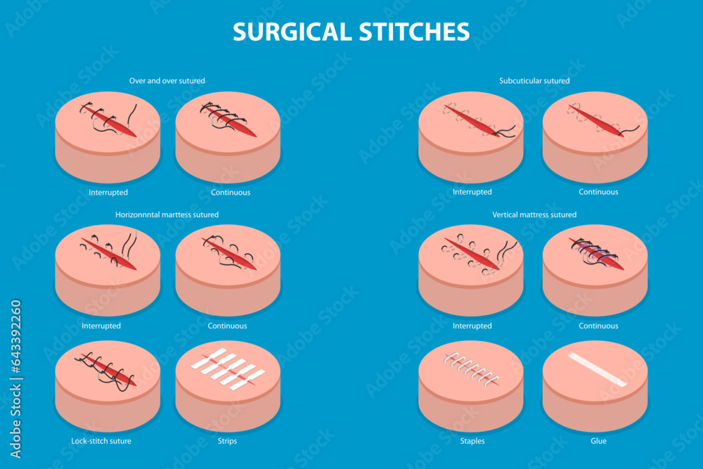 3D Isometric Flat Vector Conceptual Illustration of Surgical Stitches ...