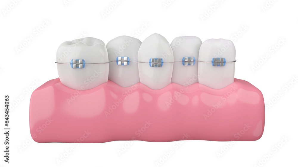 Dental braces, overlapping tooth and Dental straightening isolated ...