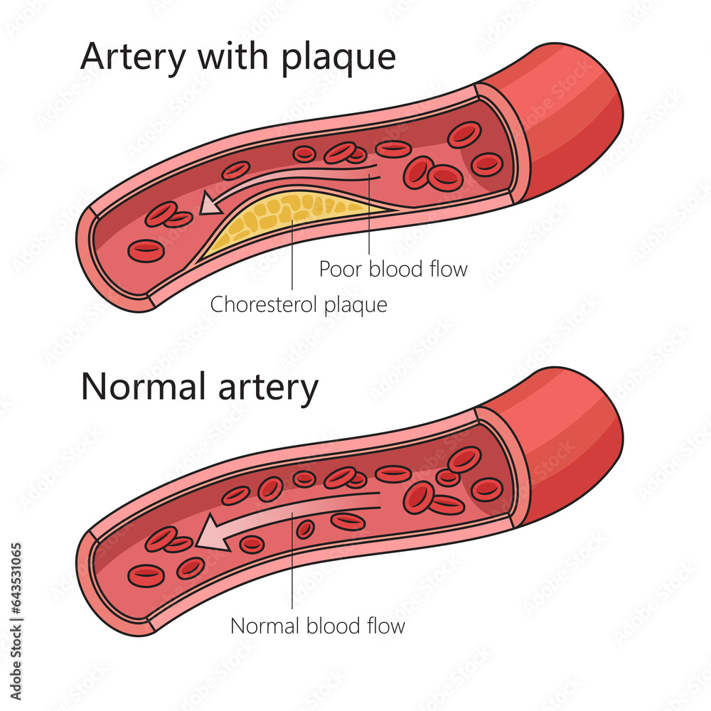 Atherosclerosis. Arteriosclerotic vascular disease artery with plaque diagram schematic raster ...