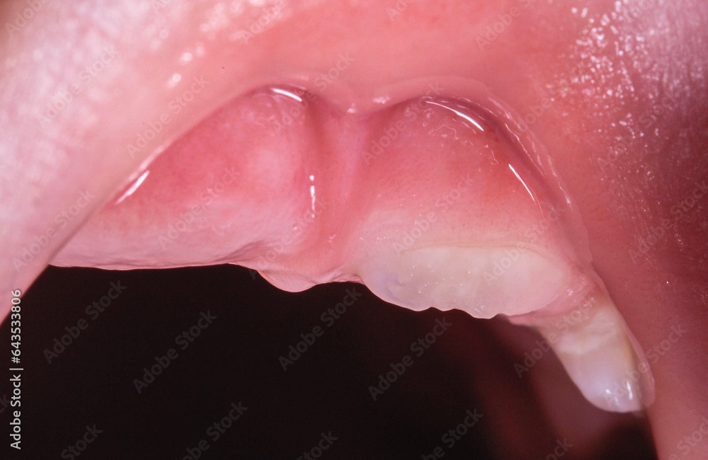 Swelling of the gums during the eruption of permanent teeth after the ...