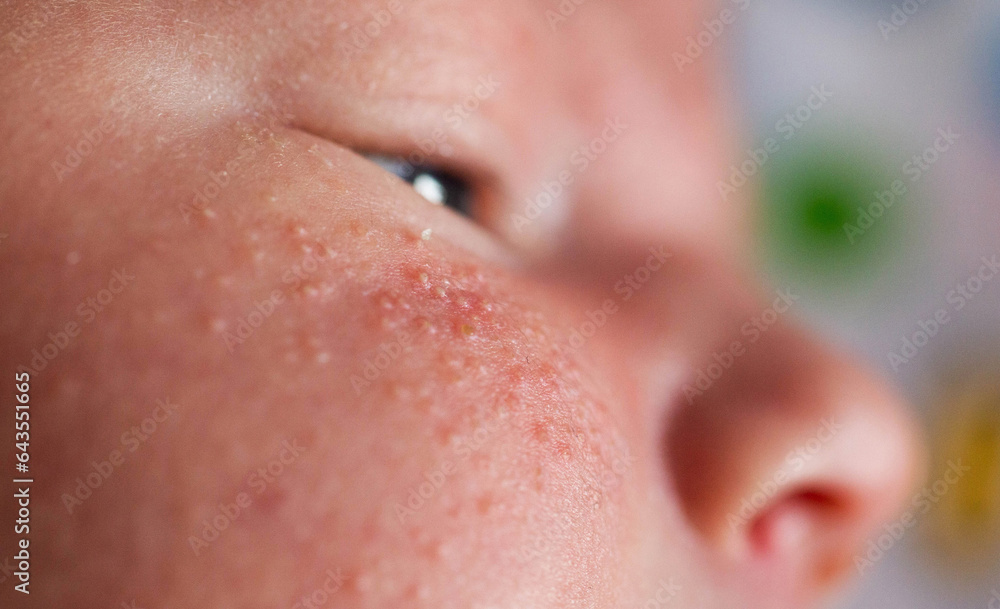 Rash on the face of a newborn baby. The process of formation of the ...